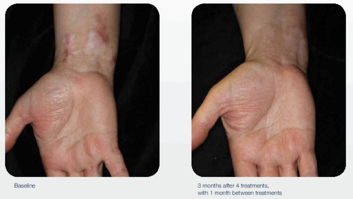 Narben von Akne oder Verbrennungen entfernen: Lasermedizin in Münster